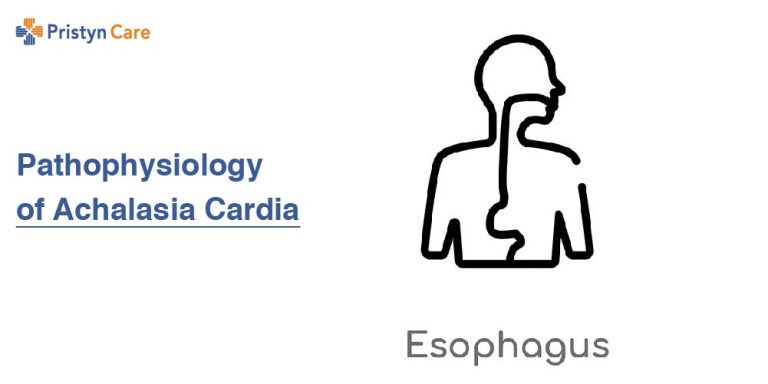 Esophageal Achalasia Wikipedia