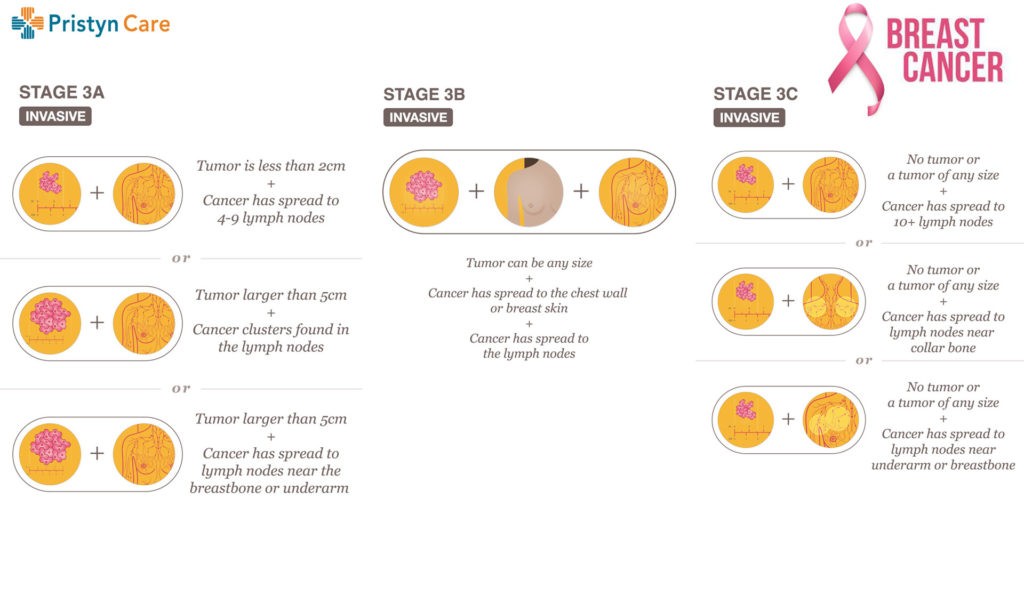 TNM Staging System for Breast Cancer - Pristyn Care