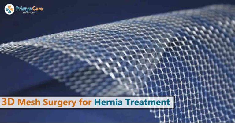 Know About 3d Mesh Surgery For Hernia Treatment