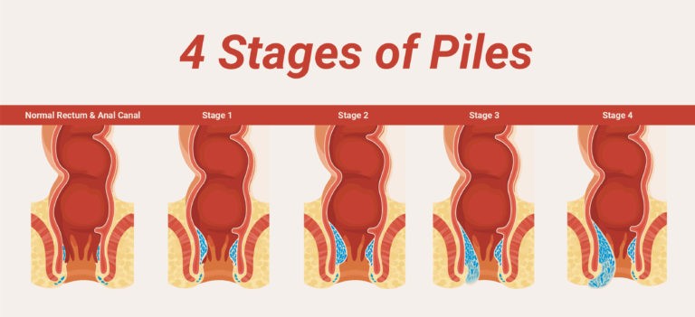 Piles Vs Fissure: Know Difference Between Piles and Fissure Piles Vs Fissure: Know Difference Between Piles and Fissure