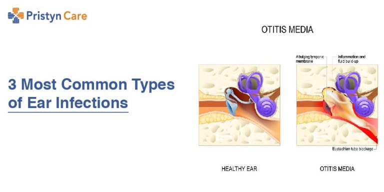 Learn more about types of ear infections