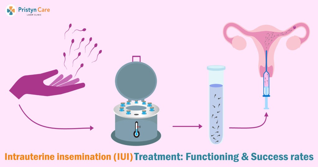 Intrauterine insemination (IUI) Treatment: Functioning & Success rates