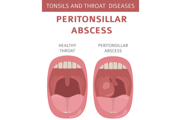 5 Major Complications of Tonsillitis - Pristyn Care