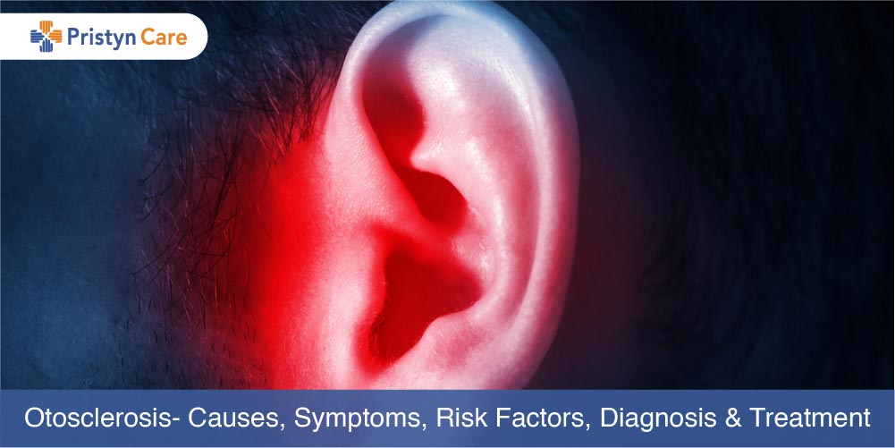Otosclerosis- Causes, Symptoms, Risk Factors, Diagnosis, and Treatment ...