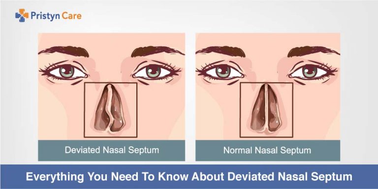 Yoga for Deviated Nasal Septum Treatment at Home