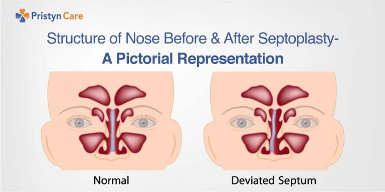 Difference Between Submucosal Resection And Septoplasty Pristyn Care