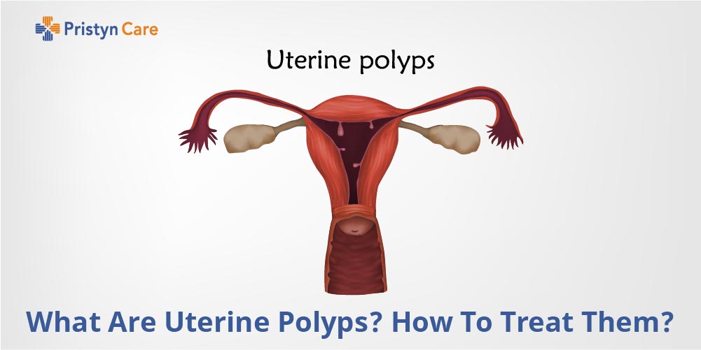 What Are Uterine Polyps How To Treat Them Pristyn Care