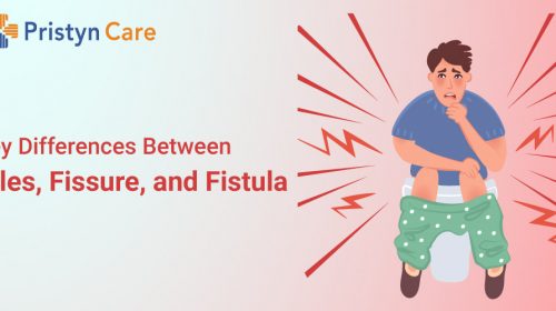 Difference Between Anal Fissures And Haemorrhoids Anemia And Piles