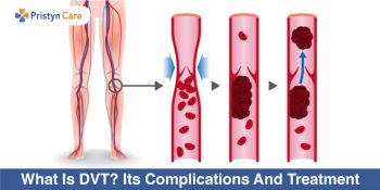 What Is DVT? Its Complications and Treatment - Pristyn Care