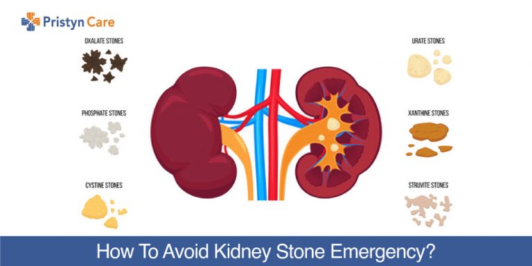 Is Exercise For Kidney Stones Effective? - Pristyn Care