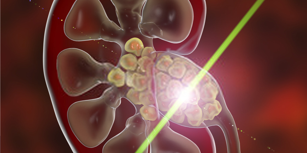 Can You Pass An 8mm Kidney Stone Pristyn Care can-you-pass-an-8mm-kidney-stone-pristyn-care