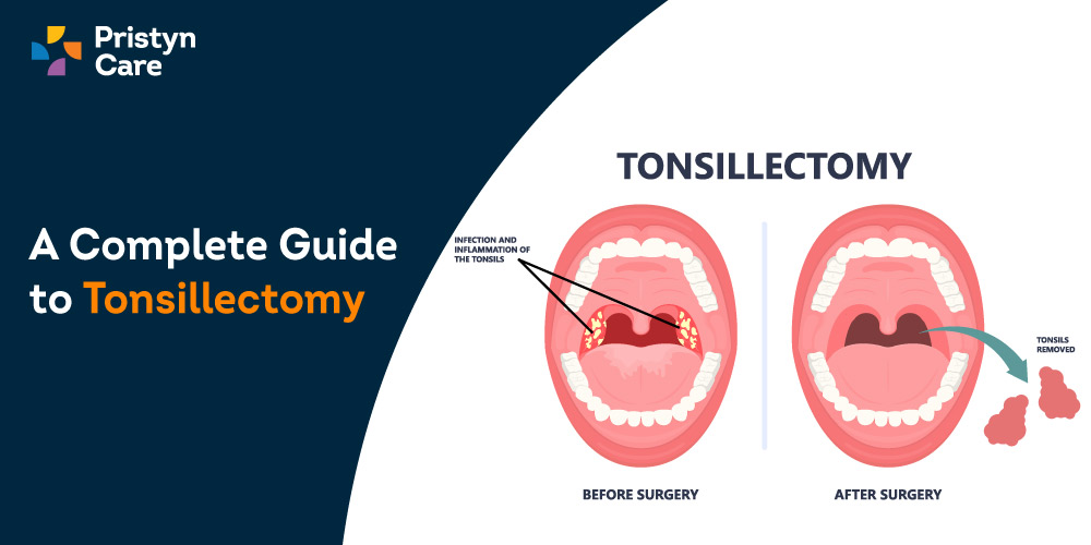 Tonsillectomy And Adenoidectomy Post Op