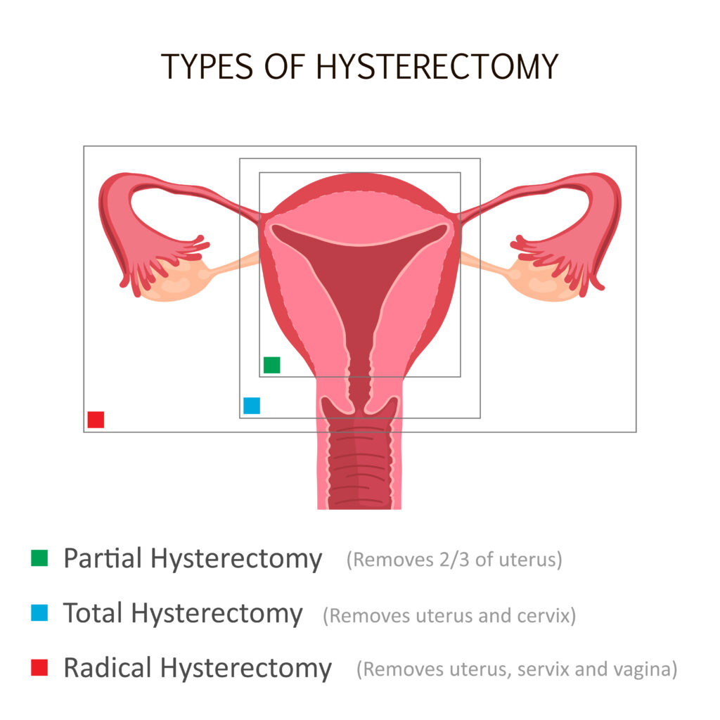 What You Need To Know About Hysterectomy Uterus Removal Surgery