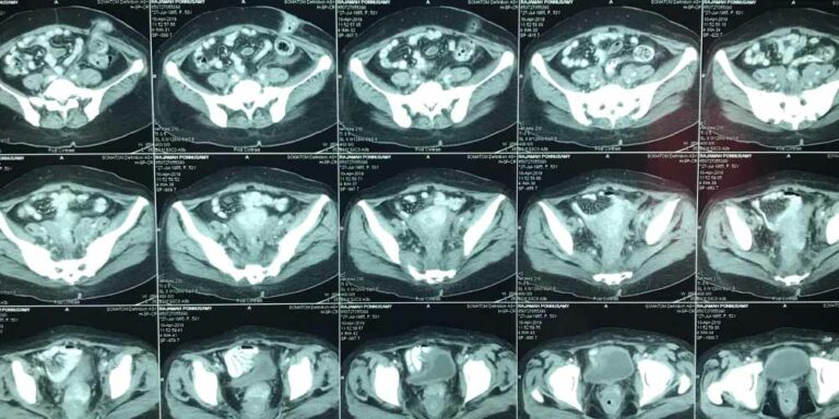 MRI For Different Anal Fistula Treatment - Pristyn Care