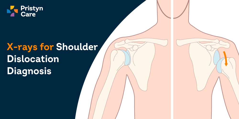 Shoulder Dislocation Shoulder Dislocation