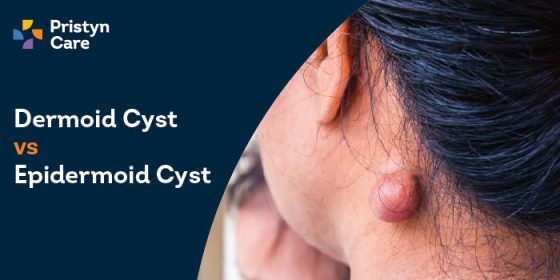 Dermoid Cyst vs Epidermoid Cyst - Pristyn Care