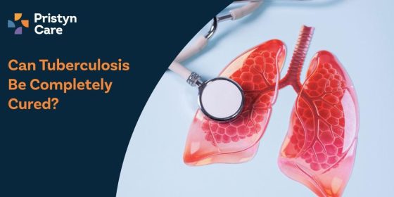 Can Tuberculosis Be Completely Cured? - Pristyn Care