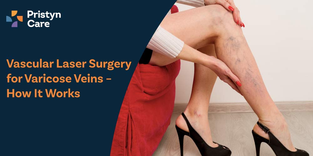 Vascular Laser Surgery for Varicose Veins – How It Works - Pristyn Care