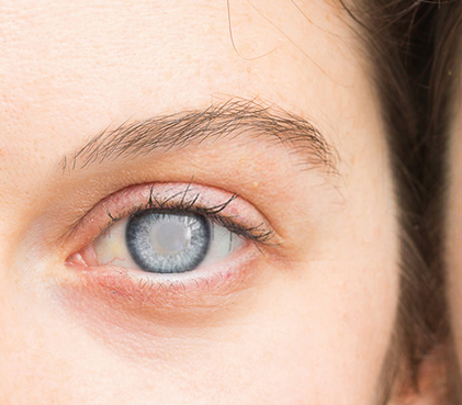 Cataract - Causes, Symptoms, Diagnosis, Treatment, Surgery, Recovery