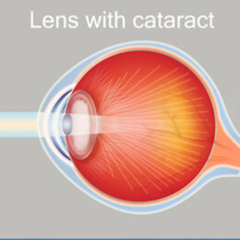 Cataract - Causes, Symptoms, Diagnosis, Treatment, Surgery, Recovery