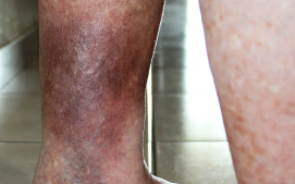 Deep Vein Thrombosis Treatment - Causes, Symptoms, Diagnosis