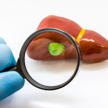 Gallstones - Causes, Symptoms, Diagnosis, Treatment, Recovery