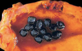 Gallstones - Causes, Symptoms, Diagnosis, Treatment, Recovery
