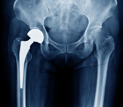 Hip Replacement- Purpose, Cost, Benefits, Risks, Recovery
