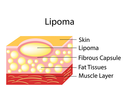 Lipoma - Treatment Types, Causes, Symptoms, Diagnosis, Risk & Recovery ...