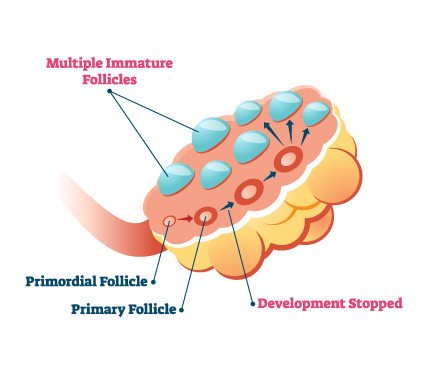 PCOD/PCOS - Causes, Symptoms, Diagnosis, Treatment, Recovery