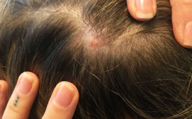 Sebaceous Cyst - Types, Causes, Symptoms, Diagnosis, Risk & Recovery