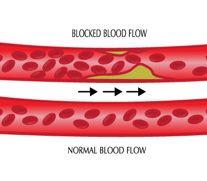 Varicocele Treatment - Causes, Symptoms, Diagnosis, Recovery