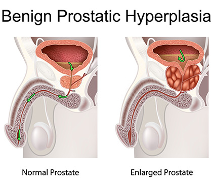 Prostate Enlargement - Everything you need to know