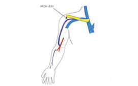 AV Fistula Surgery for Dialysis | Book Free Consultation