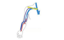 AV Fistula Surgery for Dialysis | Book Free Consultation