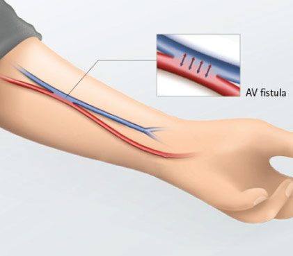 Normal Av Fistula