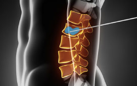 Minimally Invasive Spine Surgery