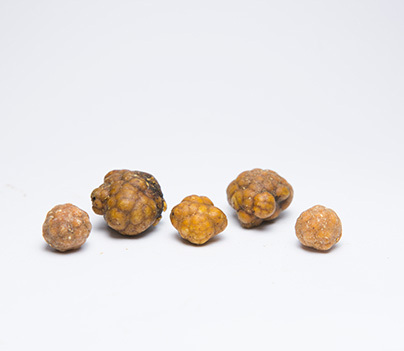 Gallbladder Stone Best Treatment in India