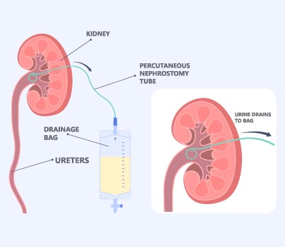 Nephrostomy Procedure - Lowest Cost Estimate