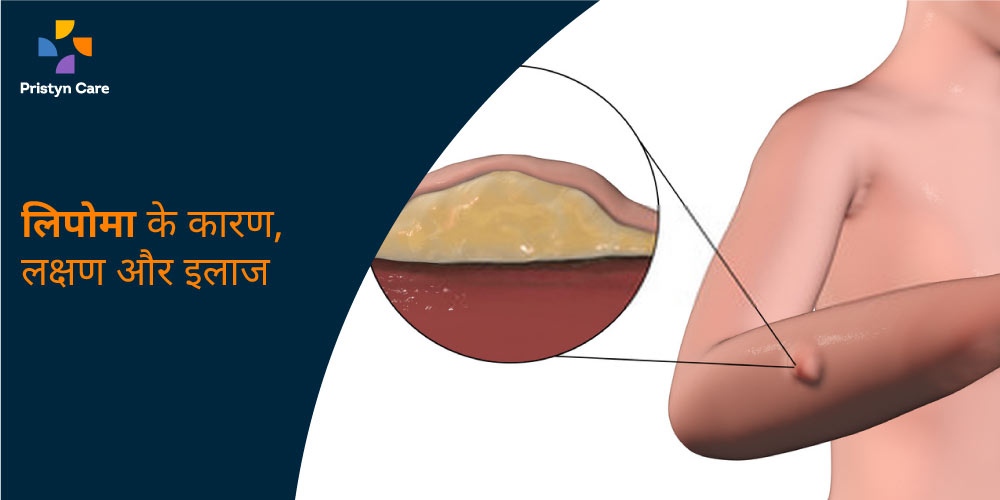 Lipoma Cancer Symptoms In Hindi Sitelip
